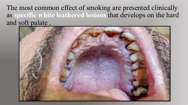 Oral lesions associated with the use of tobacco