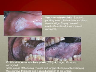 Oral lesions with dyskeratosis | PPTX