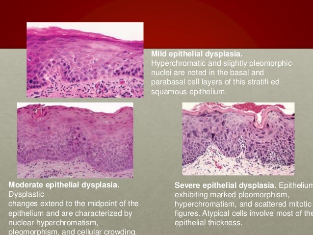 Oral lesions with dyskeratosis