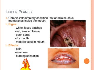 Oral lichen planus | PPTX
