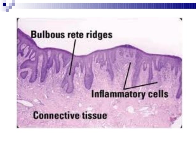 Oral Lichen Planus