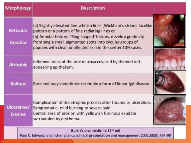 Oral Lichen Planus