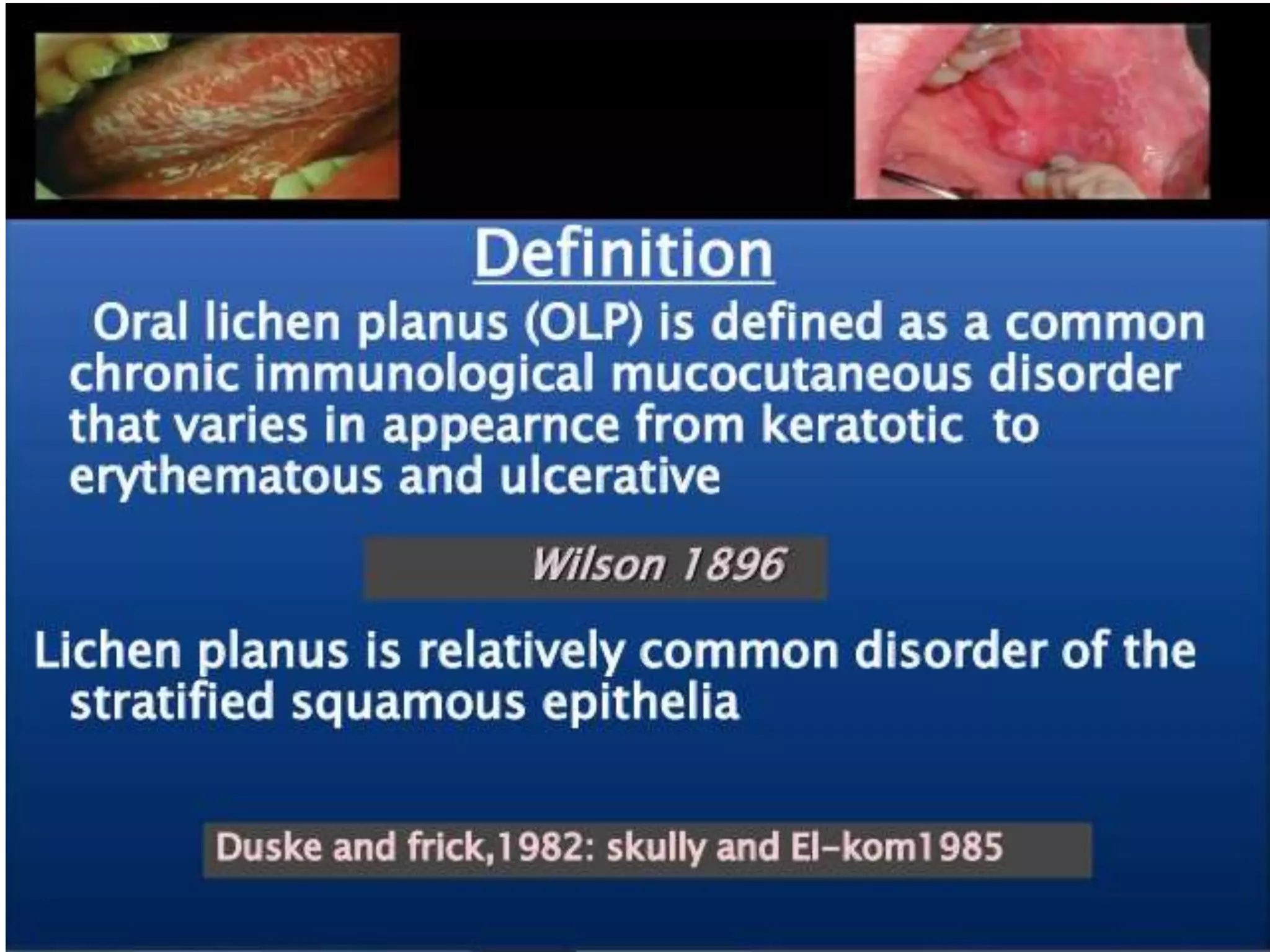 Oral lichen planus | PPT