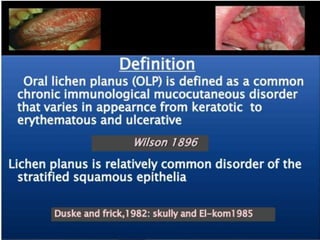 Oral lichen planus | PPTX