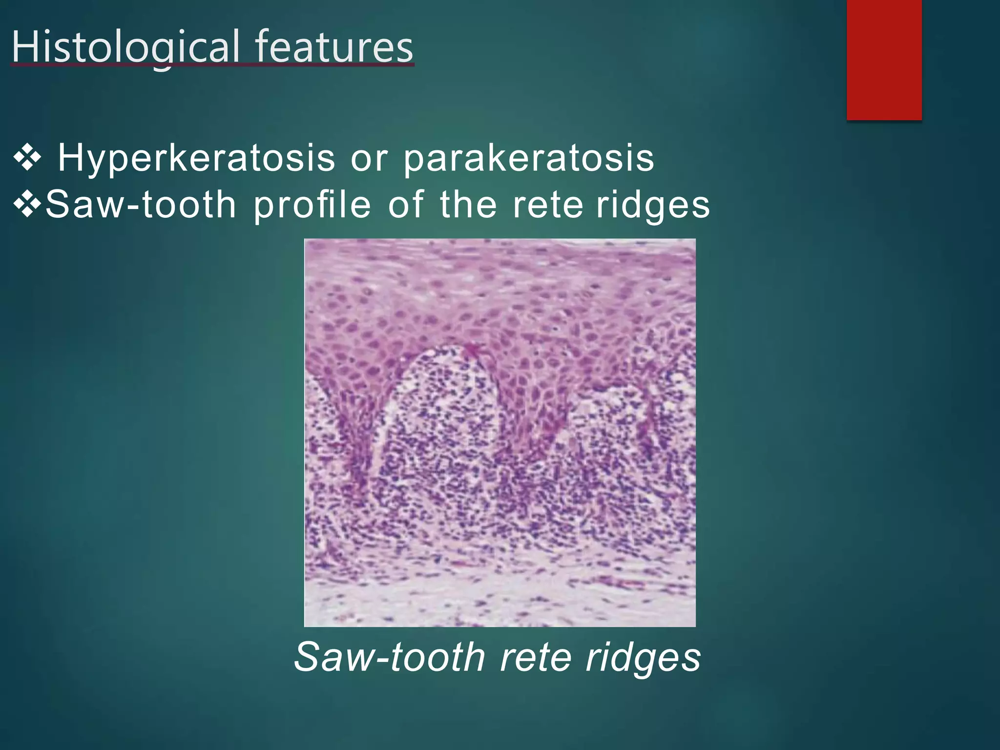 Oral lichen planus | PPTX