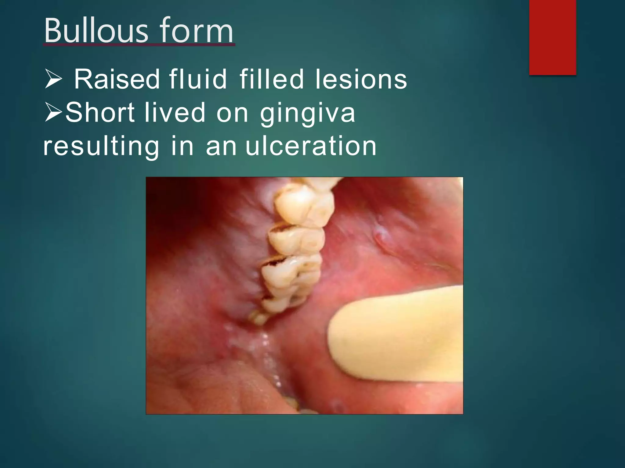 Oral lichen planus | PPTX