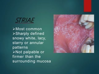 Oral lichen planus | PPTX