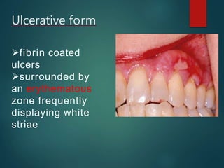 Oral lichen planus | PPTX