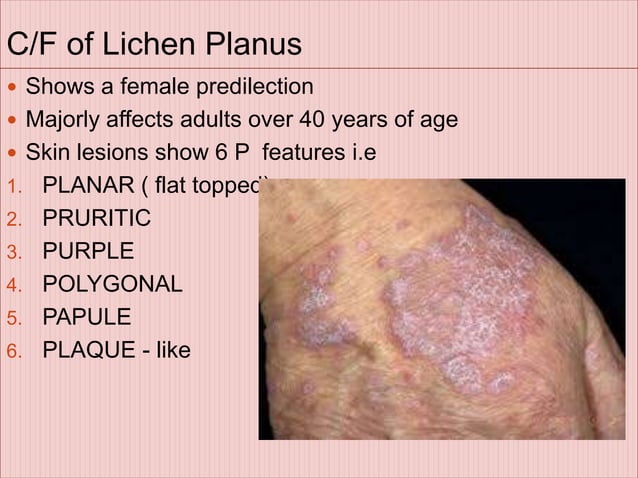 Oral lichen planus | PPTX | Skin and Dermatology | Diseases and Conditions