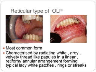 Oral lichen planus | PPTX | Skin and Dermatology | Diseases and Conditions