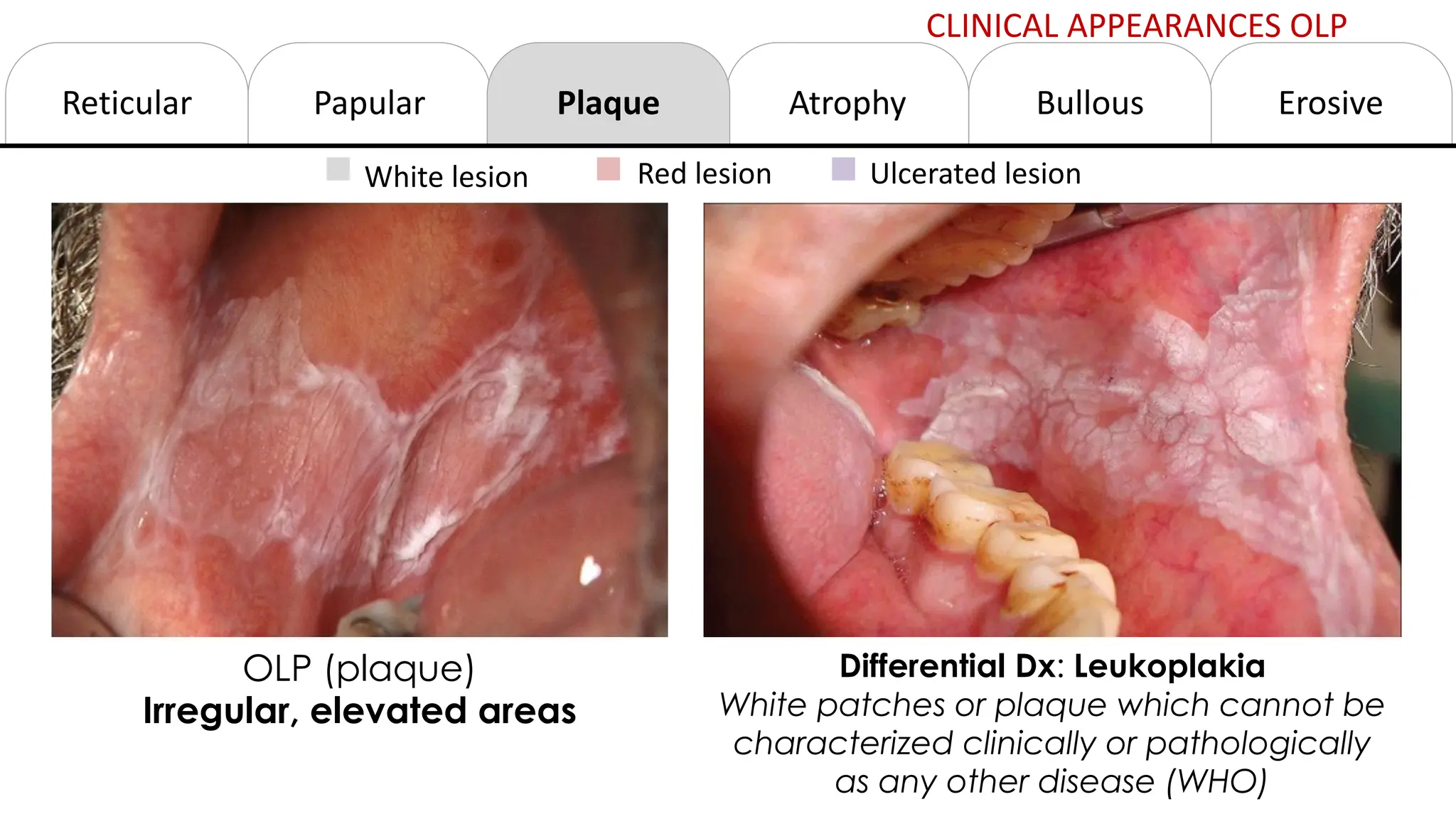 Oral Lichen Planus | PDF