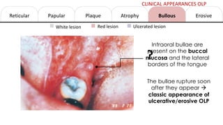 Oral Lichen Planus | PDF