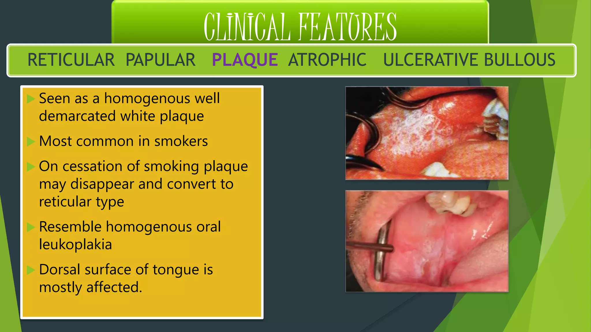 Oral lichen planus | PPTX