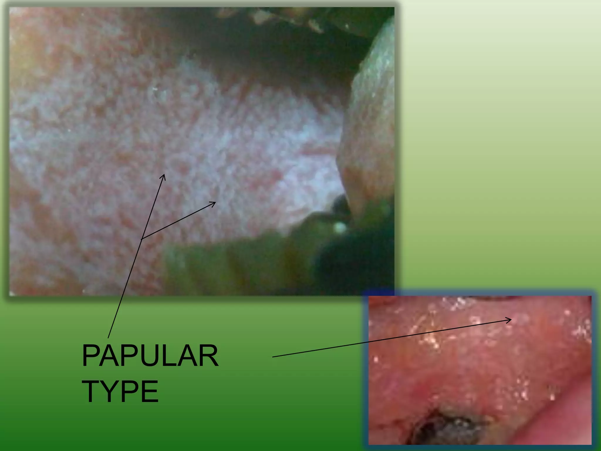 Oral Lichen Planus (OLP) | PPTX