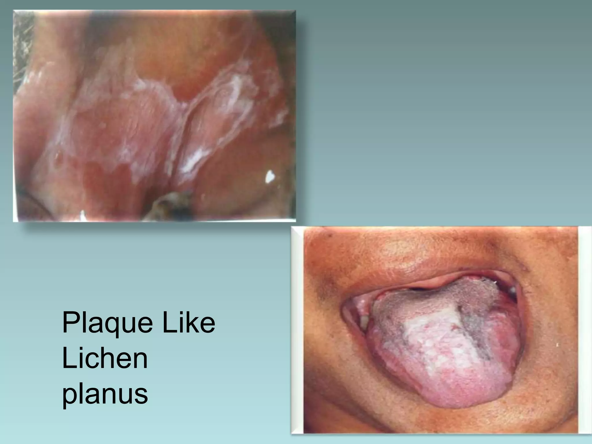 Oral Lichen Planus (OLP) | PPTX