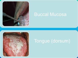 Oral Lichen Planus (OLP) | PPTX