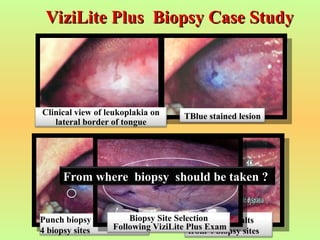Oral Lumenoscopy An Adjuvant in Early Screening of Oral Cancer.ppt