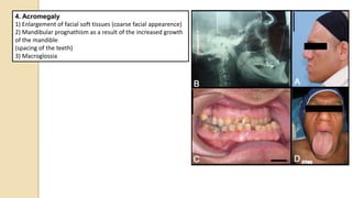 Oral manf of systemic disease | PPTX