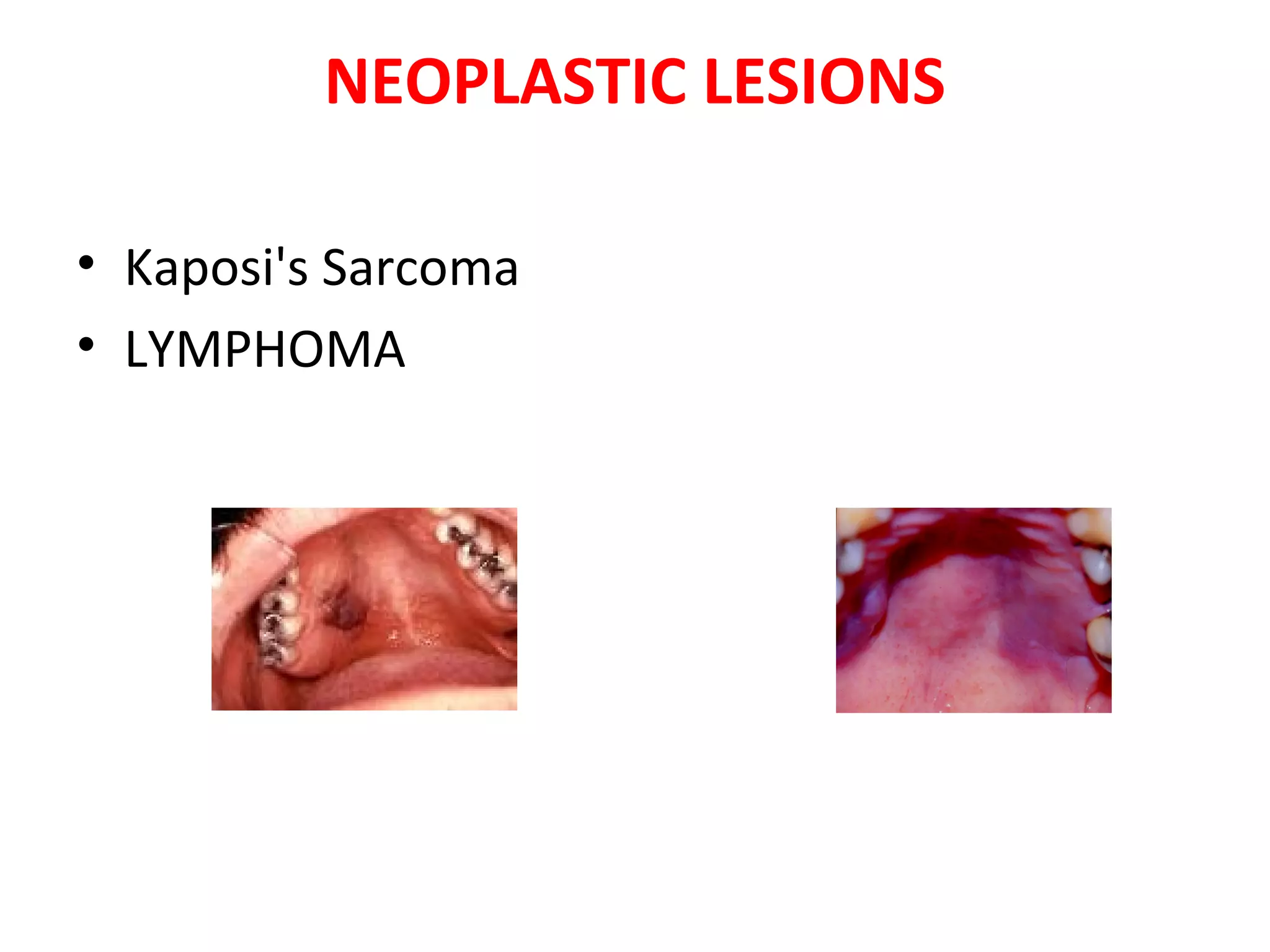 Oral manifestation of AIDS | PPT