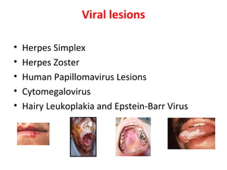 Oral manifestation of AIDS | PPT