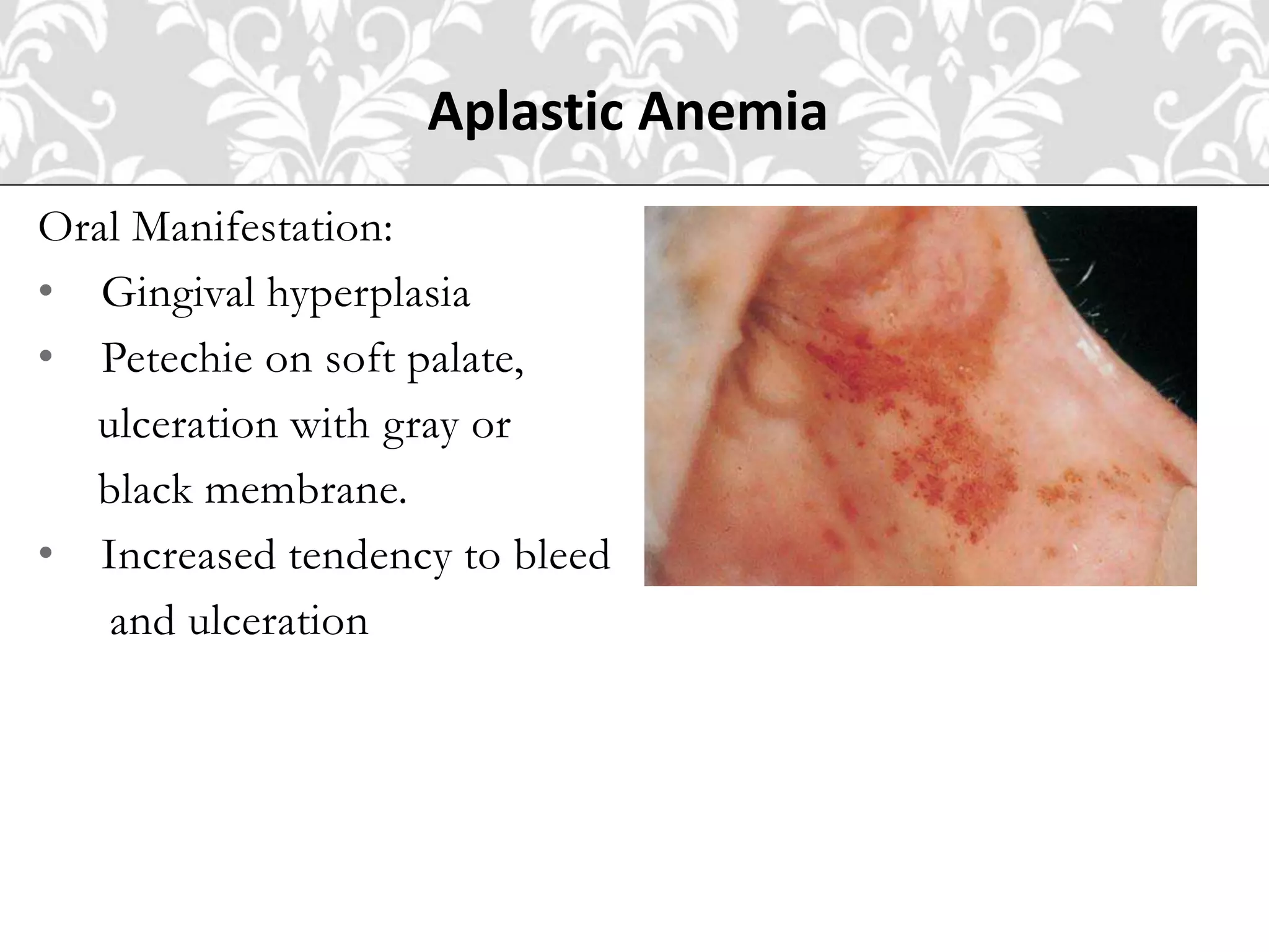 Oral manifestation of bleeding disorders | PPTX
