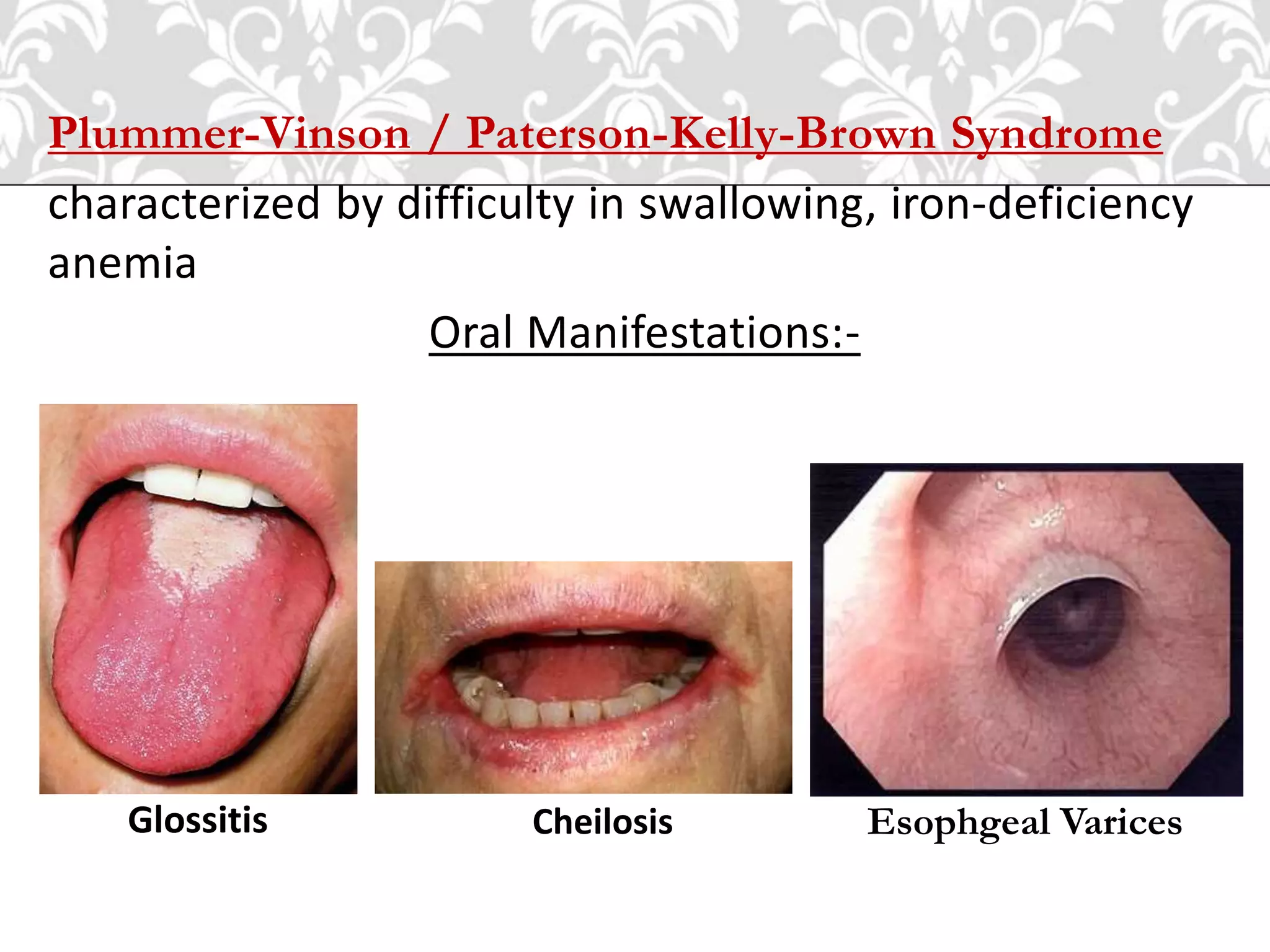 Oral manifestation of bleeding disorders | PPTX
