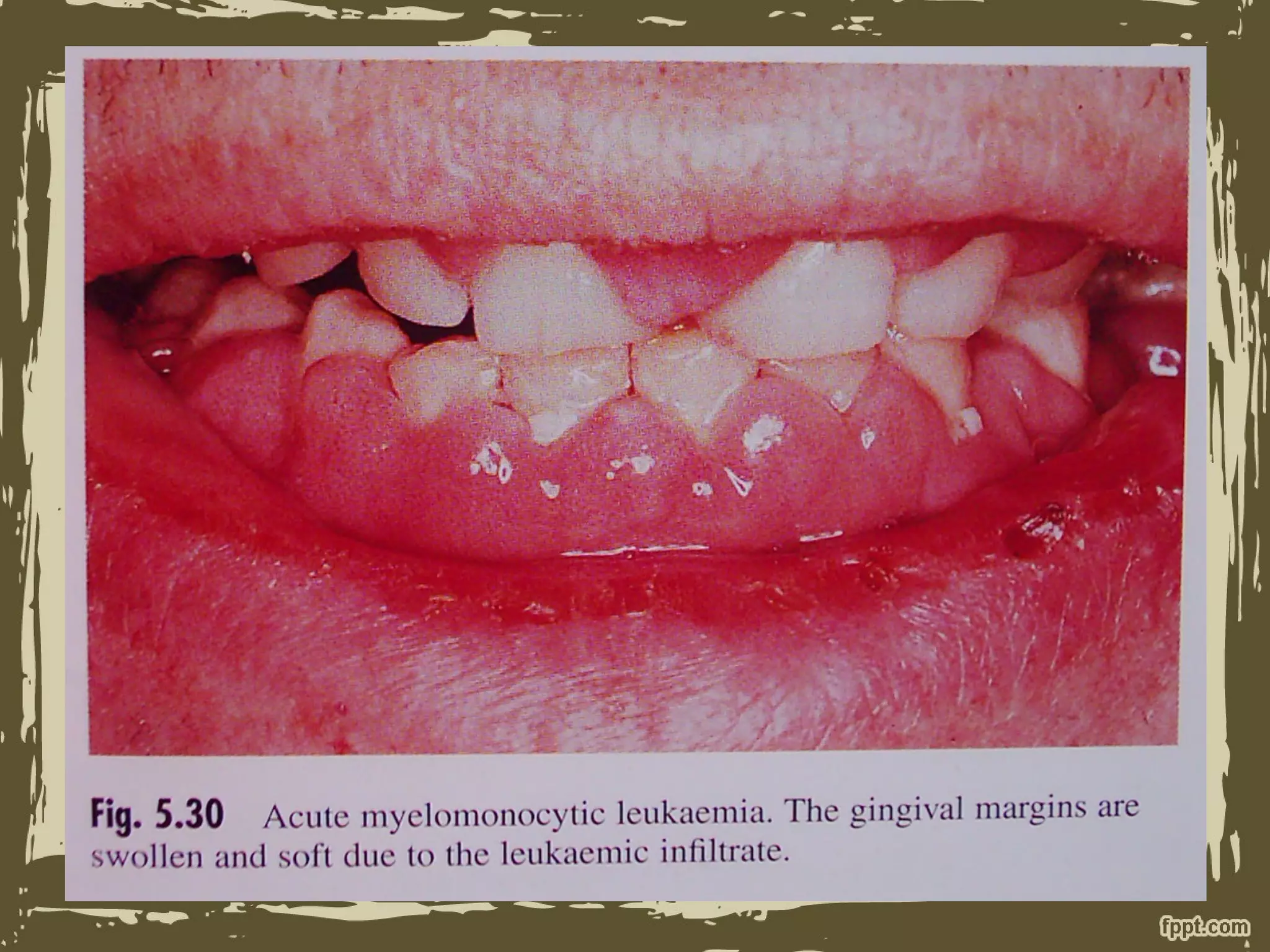 Oral manifestation of leukemia | PPT