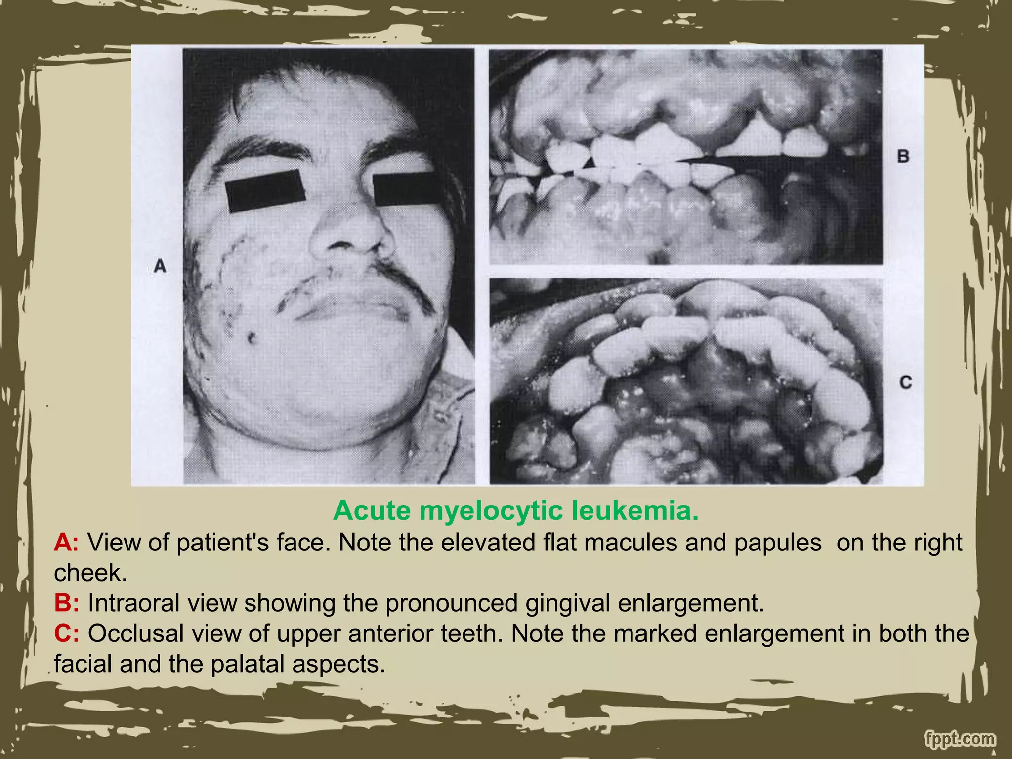 Oral manifestation of leukemia | PPT