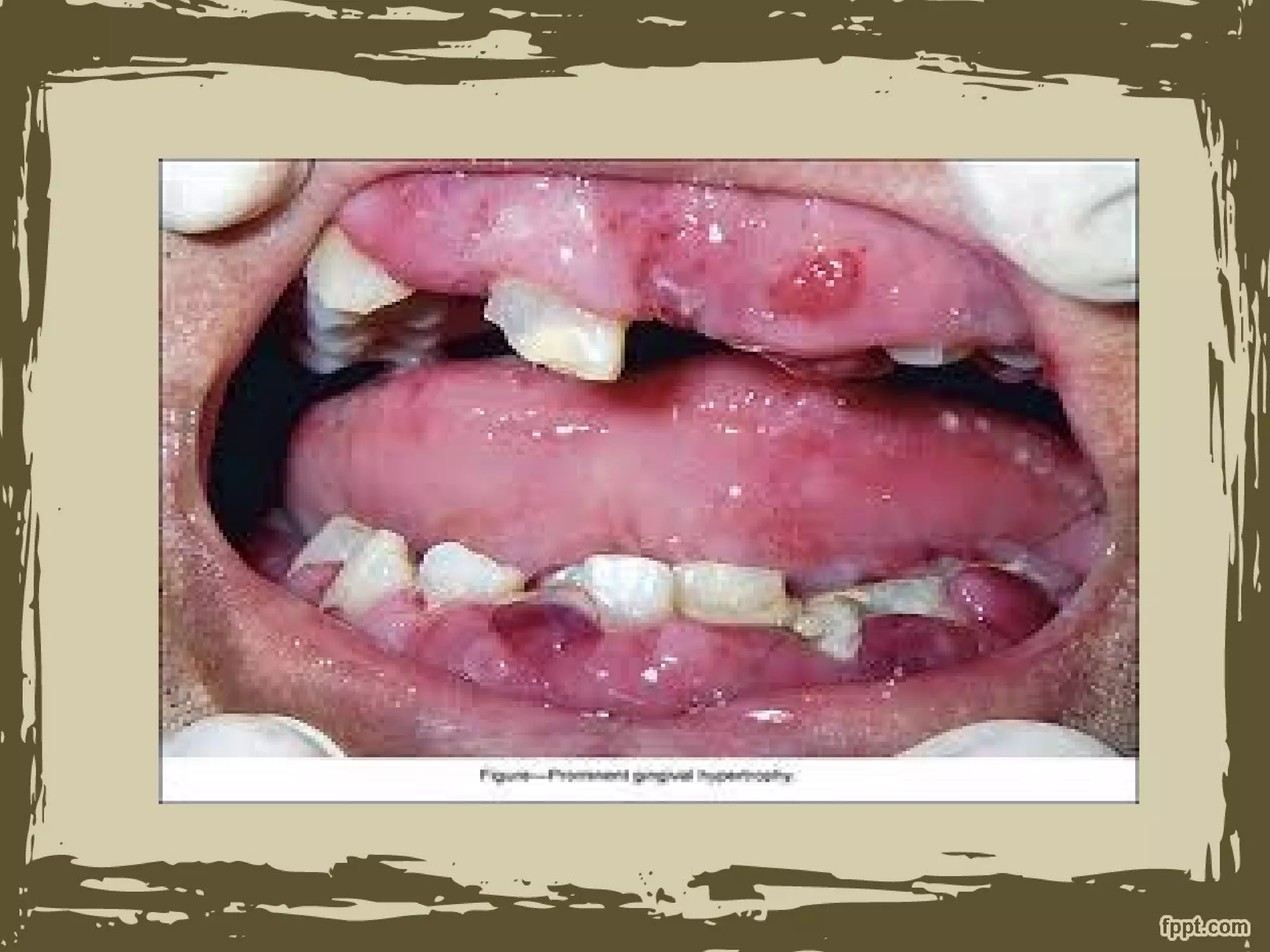 Oral manifestation of leukemia | PPT