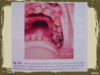 Oral manifestation of leukemia | PPT