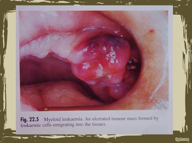 Oral manifestation of leukemia | PPT