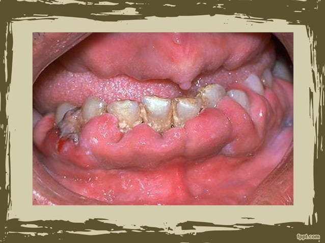 Oral manifestation of leukemia | PPT