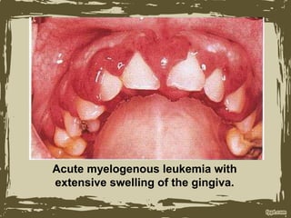 Oral manifestation of leukemia | PPT