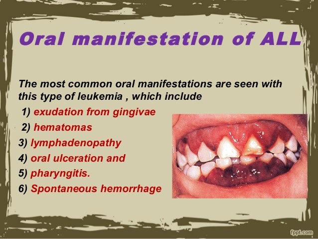 Oral manifestation of leukemia