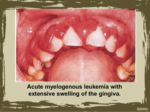 Oral manifestation of leukemia