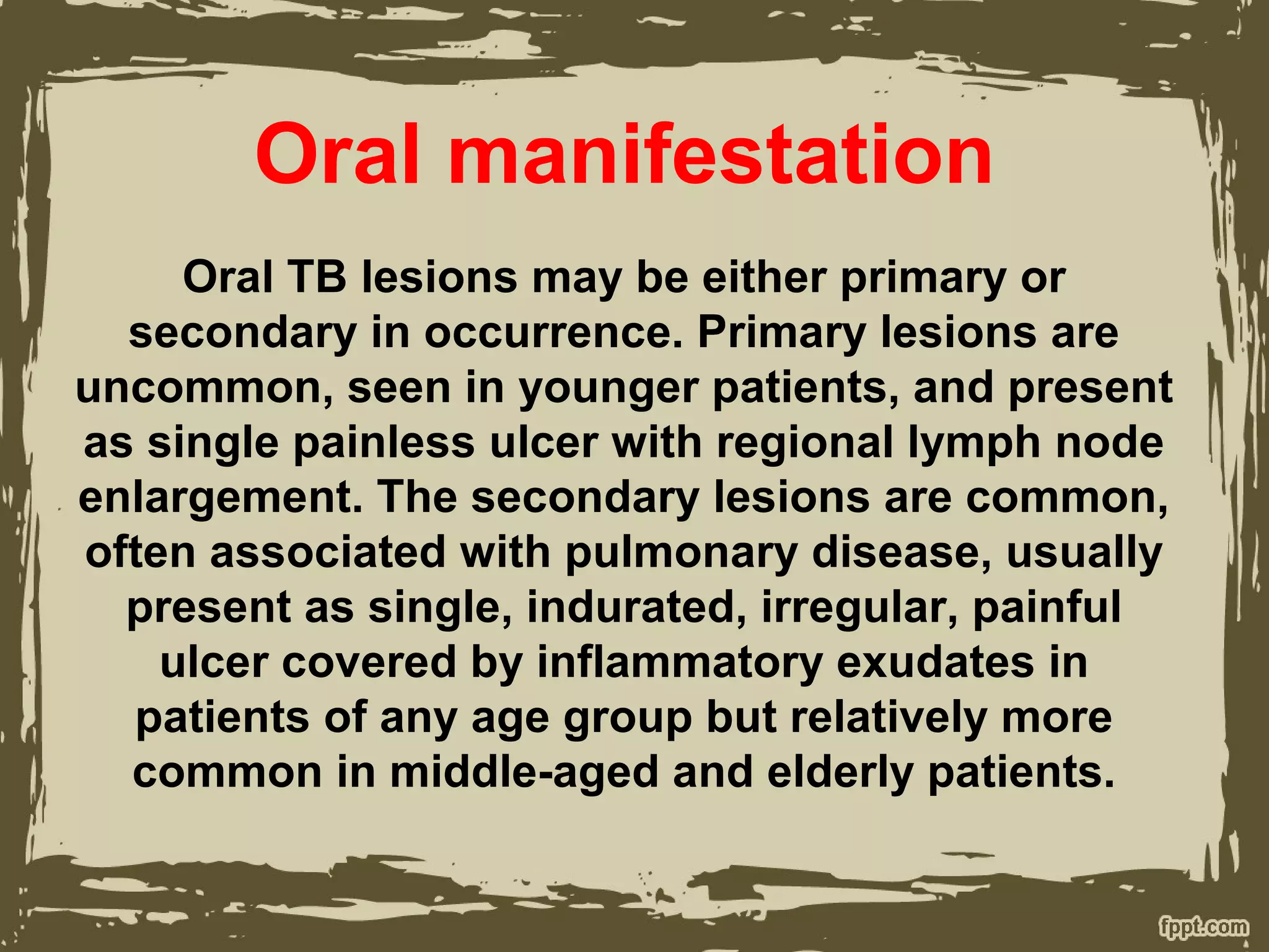 Oral manifestation of tuberculosis | PPT