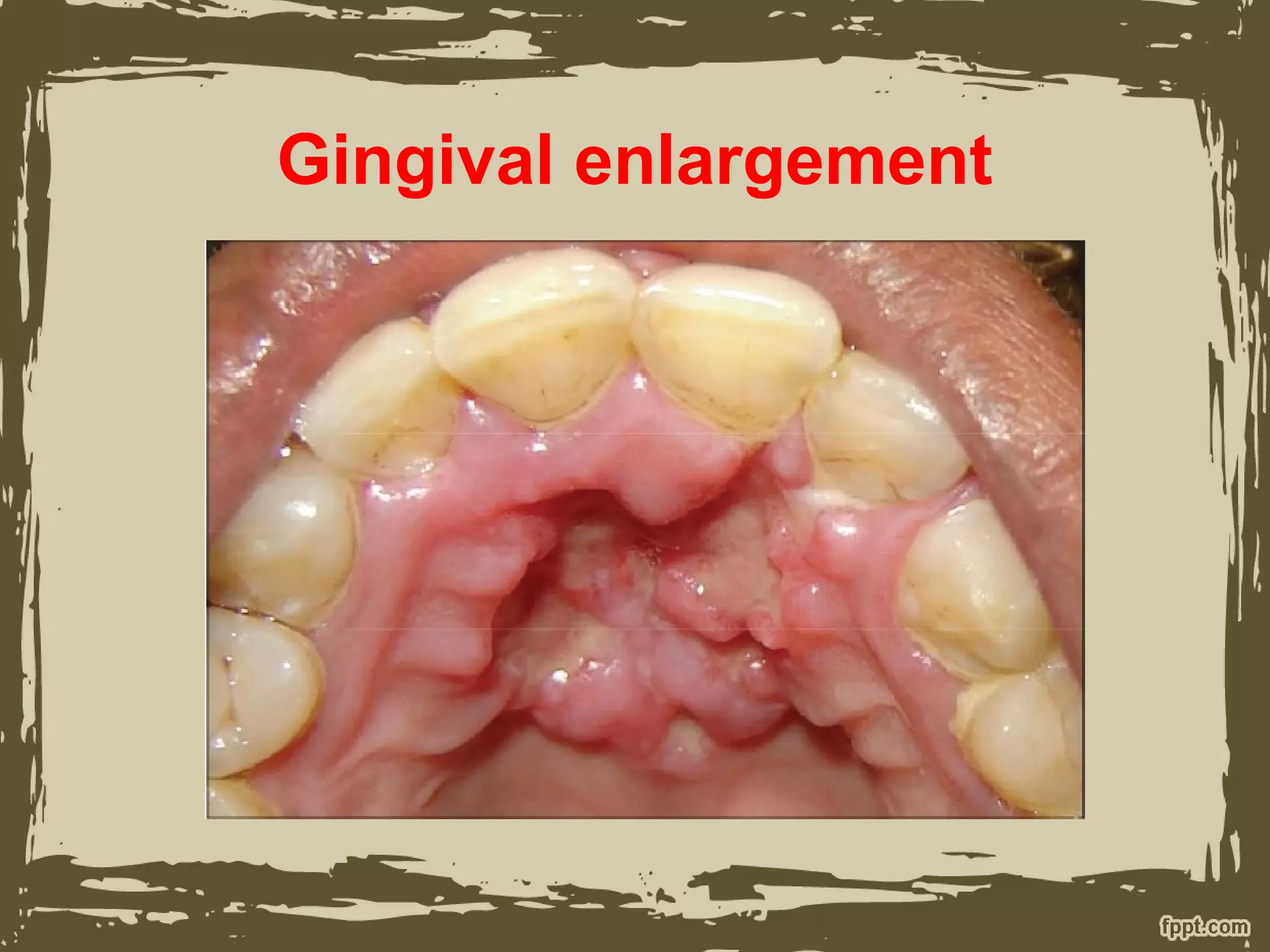 Oral manifestation of tuberculosis | PPT