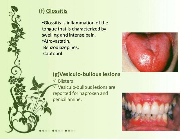 Medications That Cause Glossitis