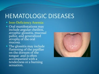 Atrophic Glossitis Iron Deficiency Anemia
