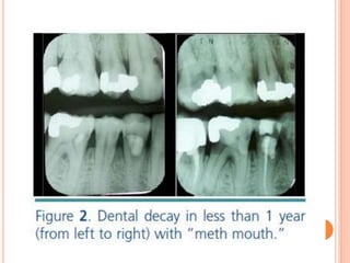 Oral manifestations in hiv disease | PPTX