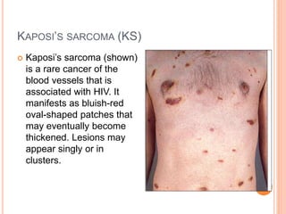 Oral manifestations in hiv disease | PPTX