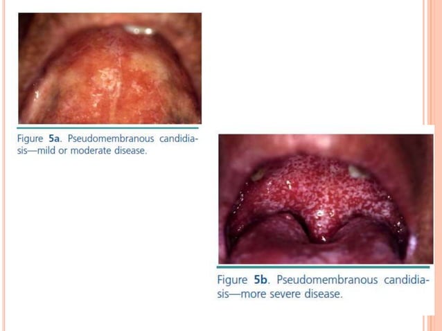 Oral manifestations in hiv disease | PPT