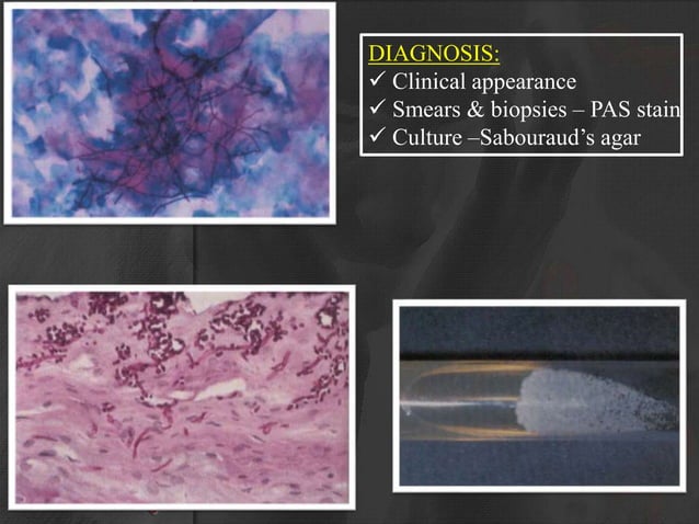 Oral manifestations of AIDS - ACQUIRED IMMUNO DEFICIENCY SYNDROME [ HIV ...