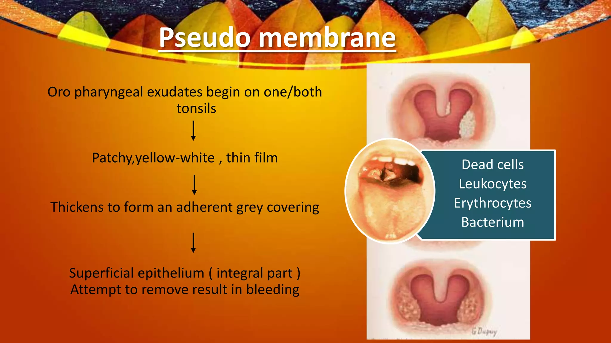 Oral manifestations of bacterial infections | PPTX
