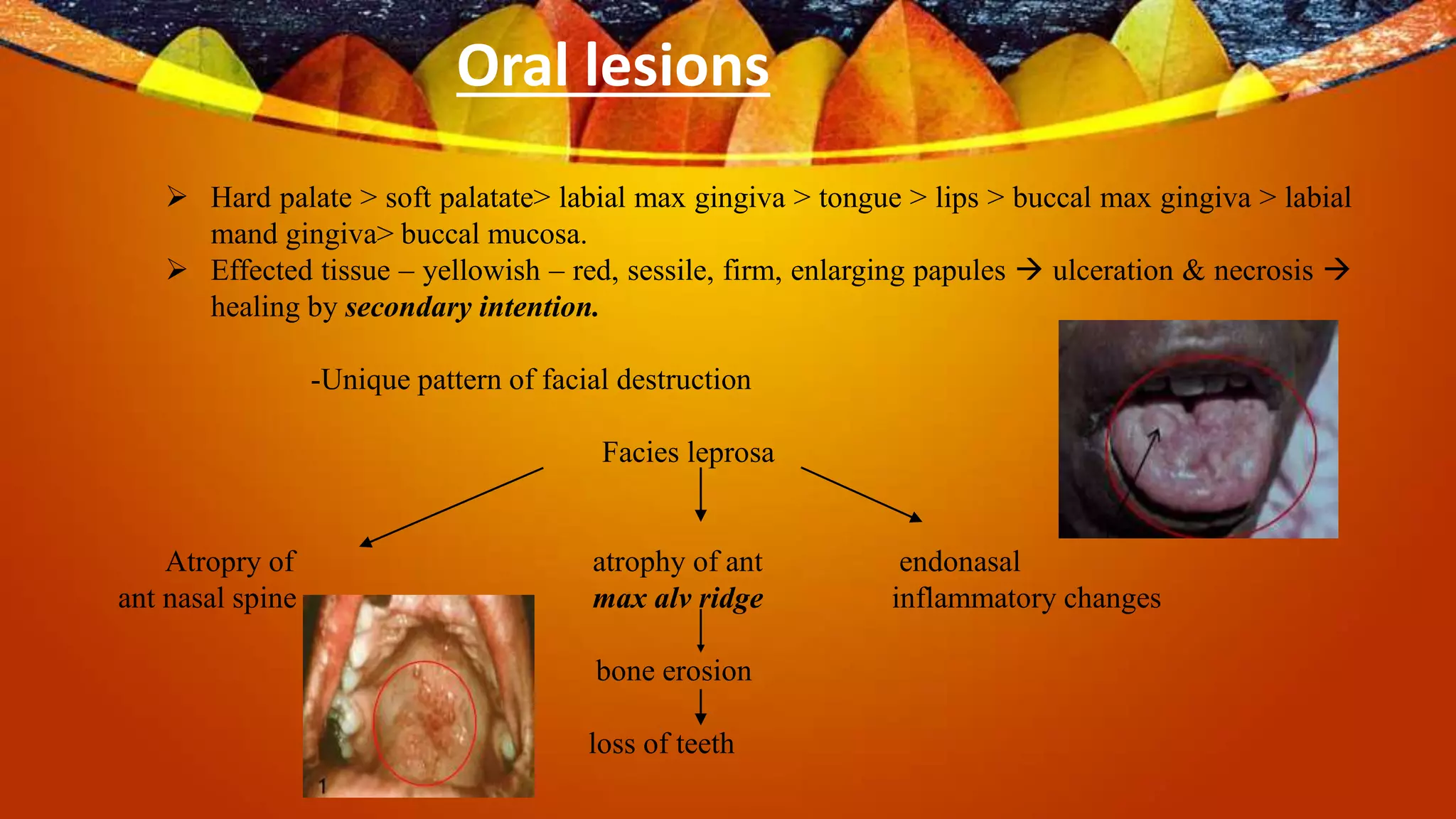 Oral manifestations of bacterial infections | PPTX