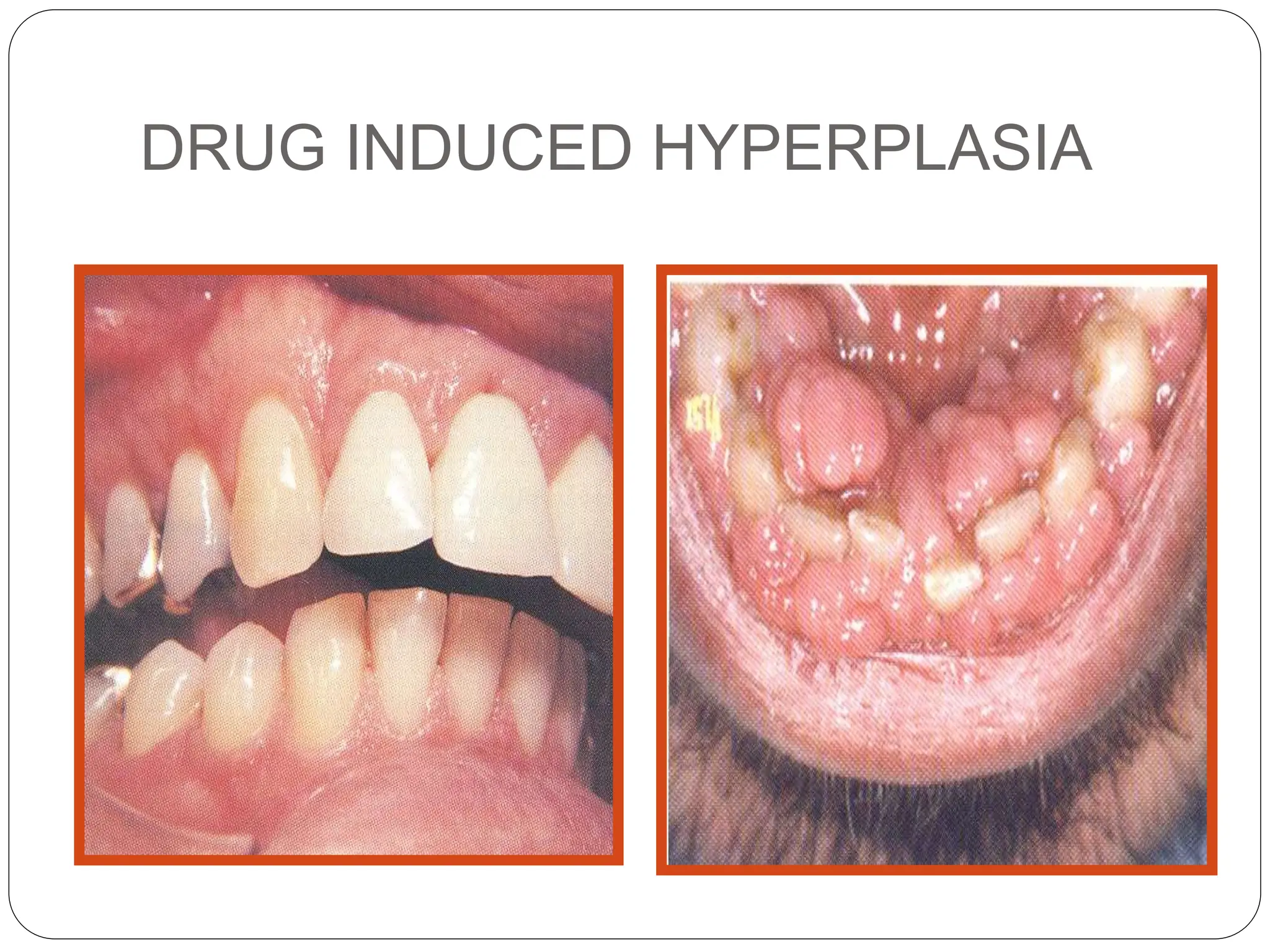 ORAL MANIFESTATIONS OF DRUG REACTIONS.ppt