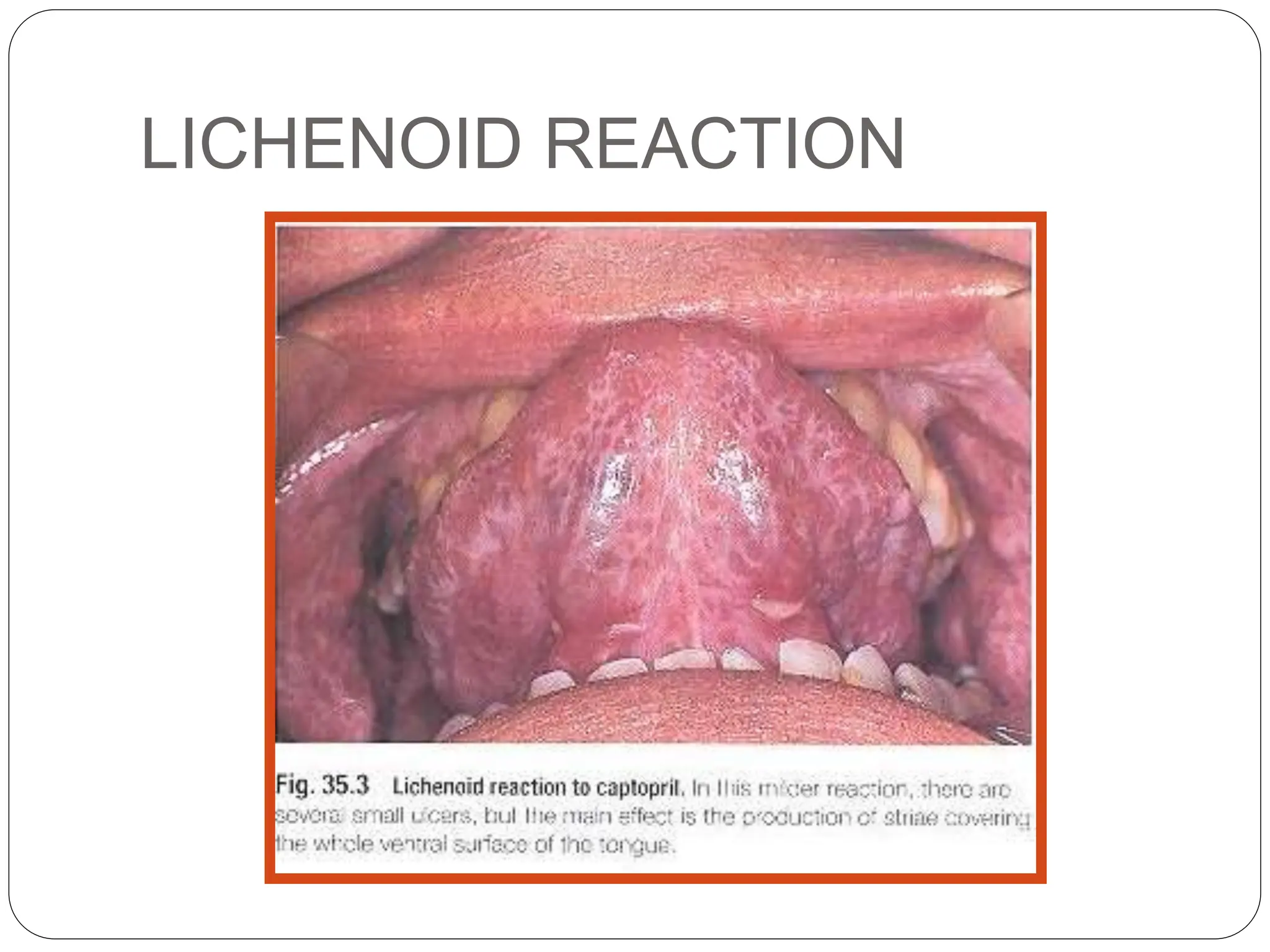 ORAL MANIFESTATIONS OF DRUG REACTIONS.ppt