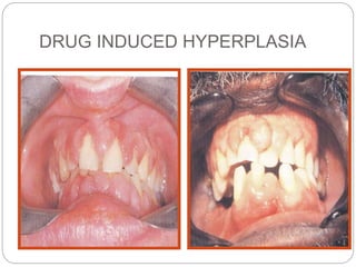 ORAL MANIFESTATIONS OF DRUG REACTIONS.ppt