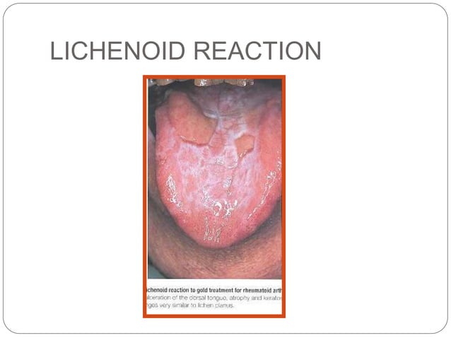 ORAL MANIFESTATIONS OF DRUG REACTIONS.ppt
