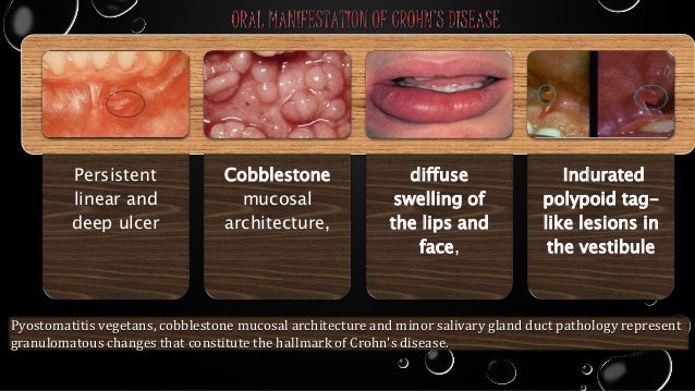 Oral manifestations of gastrointestinal disorders.ppt